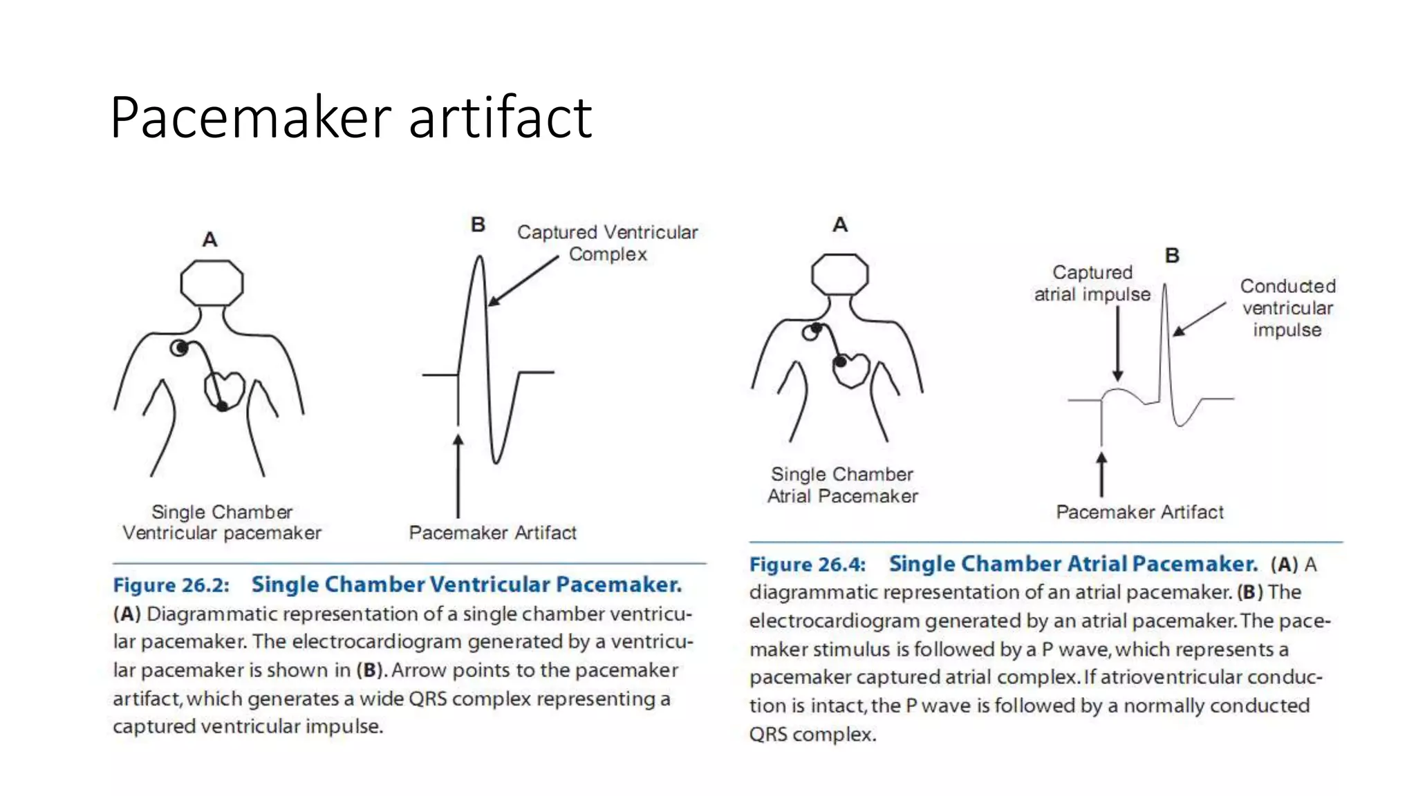 Pacemaker ecg | PPTX