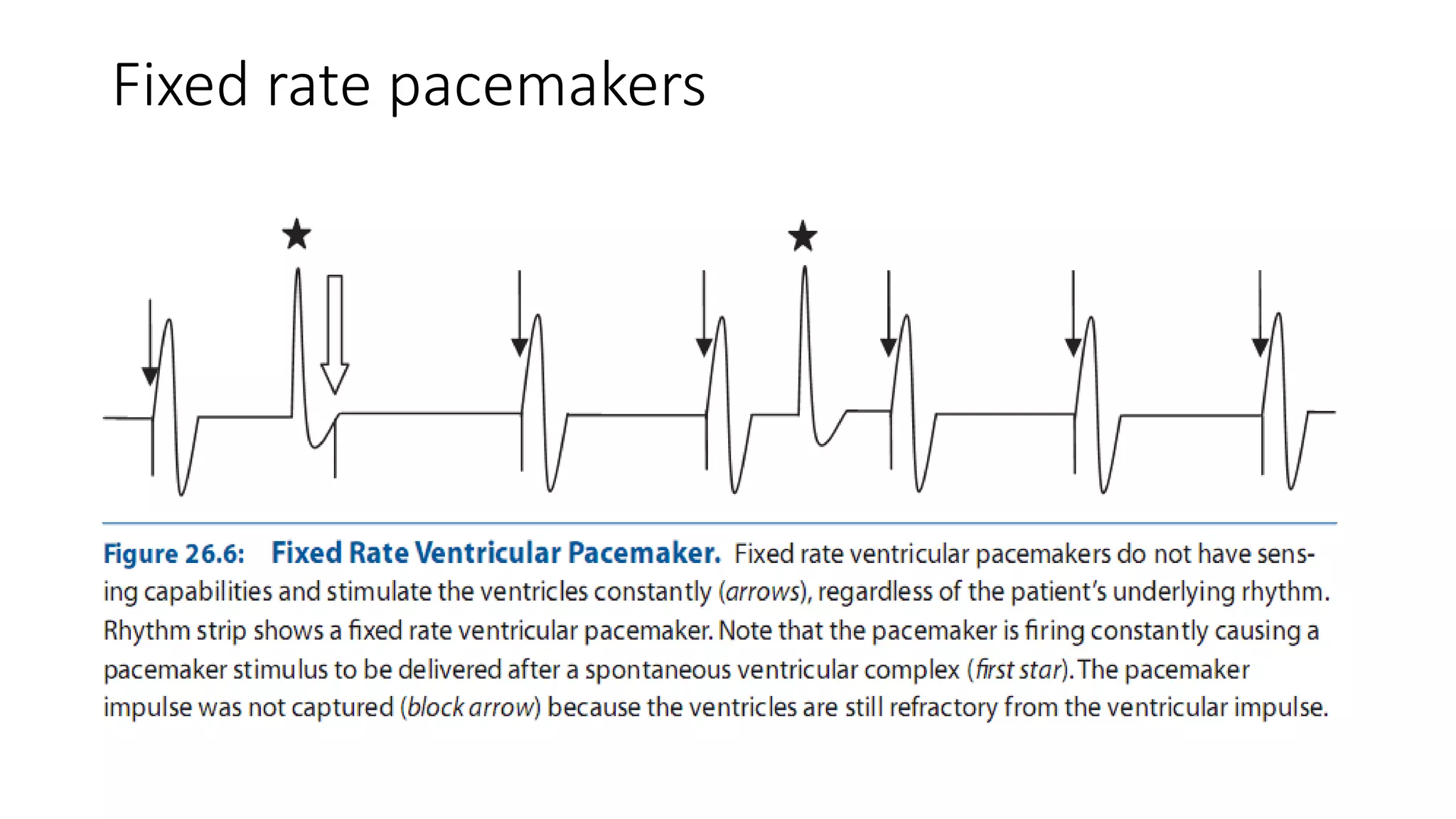 Pacemaker ecg | PPTX