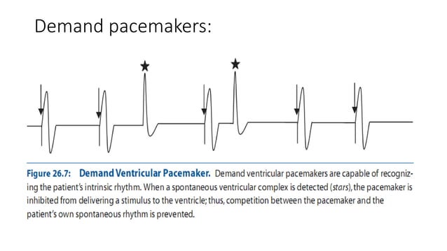 Pacemaker ecg | PPTX