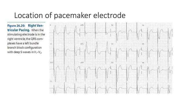 Pacemaker ecg | PPTX