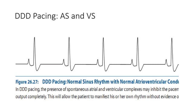 Pacemaker ecg | PPTX