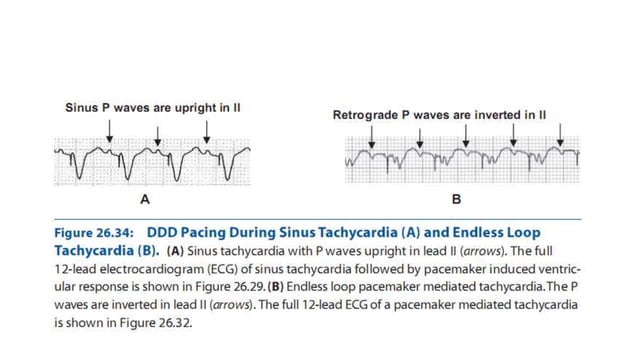Pacemaker ecg | PPTX