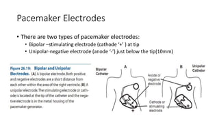 Pacemaker ecg | PPTX