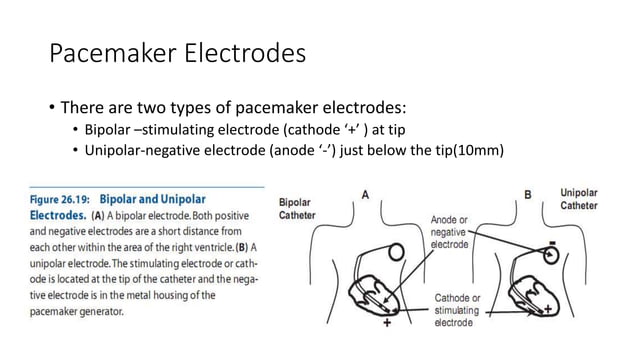 Pacemaker ecg | PPTX