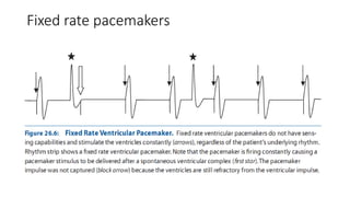 Pacemaker ecg | PPTX