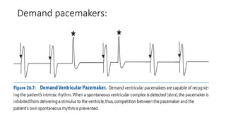 Pacemaker ecg | PPT
