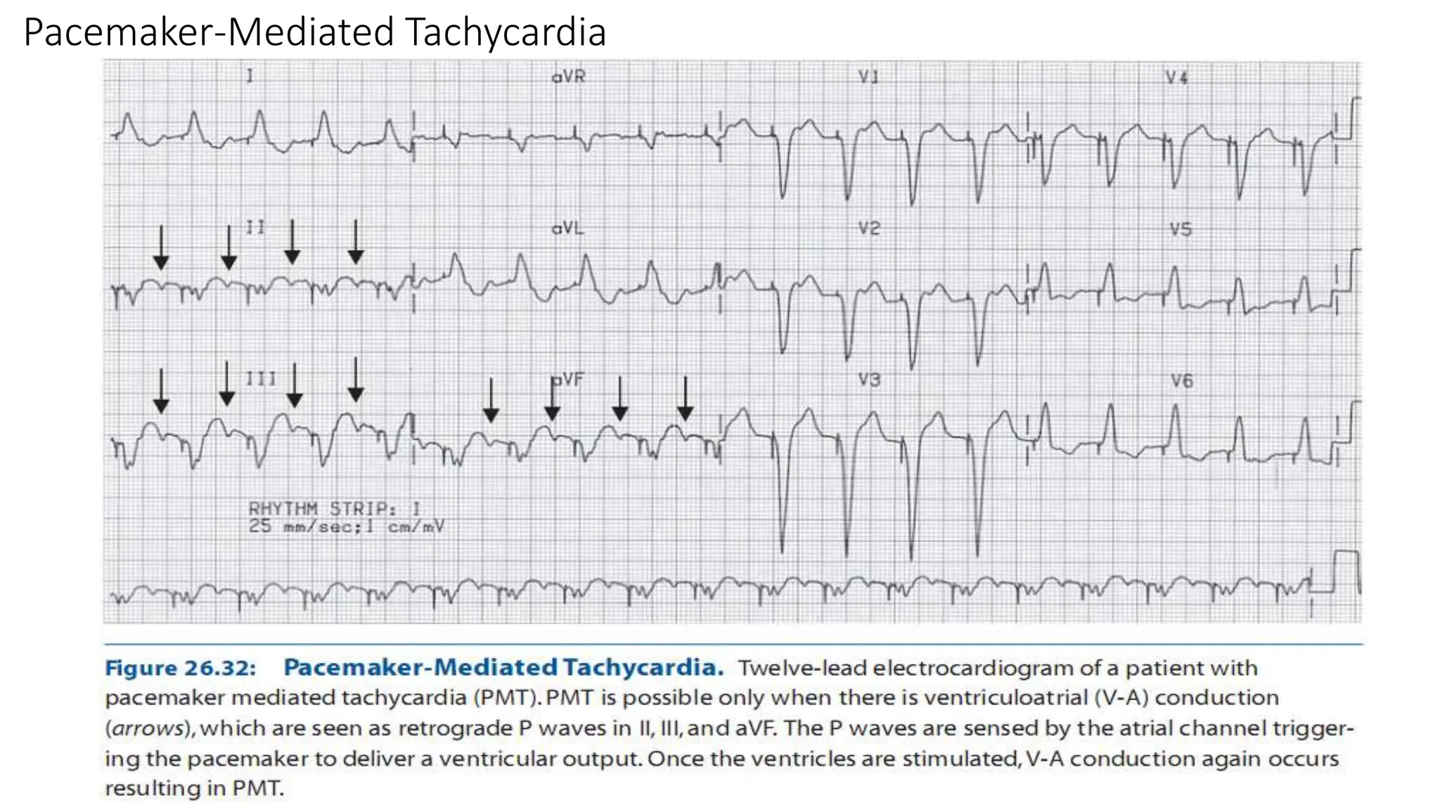 pACE MAKER ELECTROCARDIOGRAPHY-reinaldi.pptx