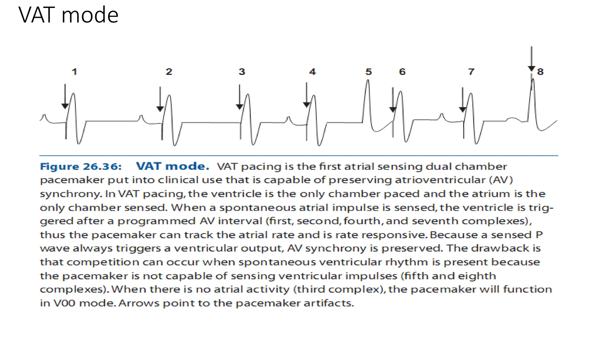 pACE MAKER ELECTROCARDIOGRAPHY-reinaldi.pptx