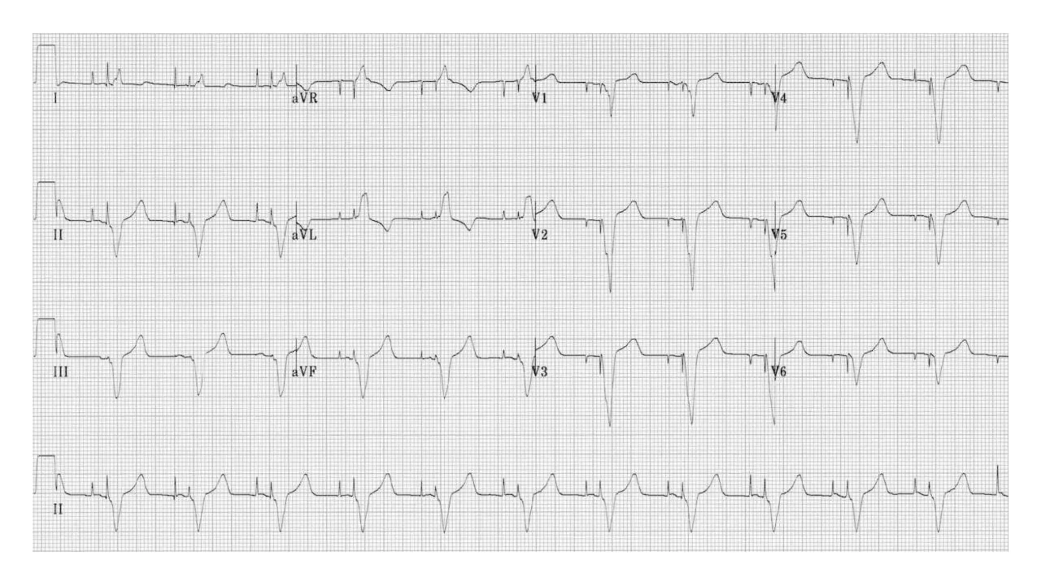 pACE MAKER ELECTROCARDIOGRAPHY-reinaldi.pptx