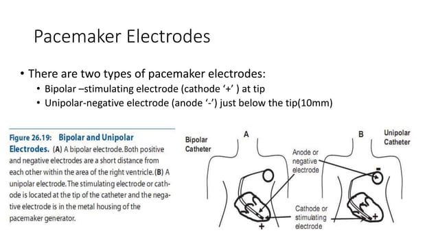 pACE MAKER ELECTROCARDIOGRAPHY-reinaldi.pptx