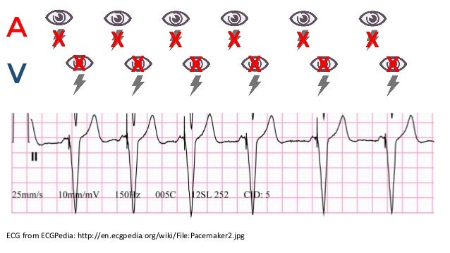 Pacemaker Rhythms