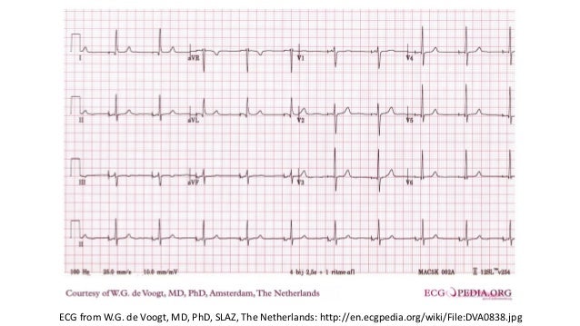 Pacemaker Rhythms