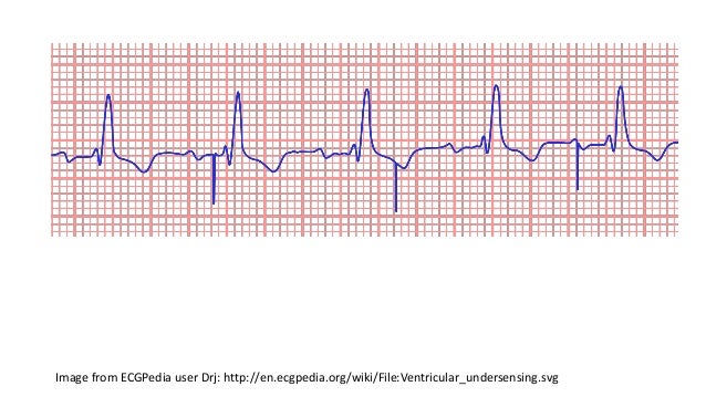 Pacemaker Rhythms