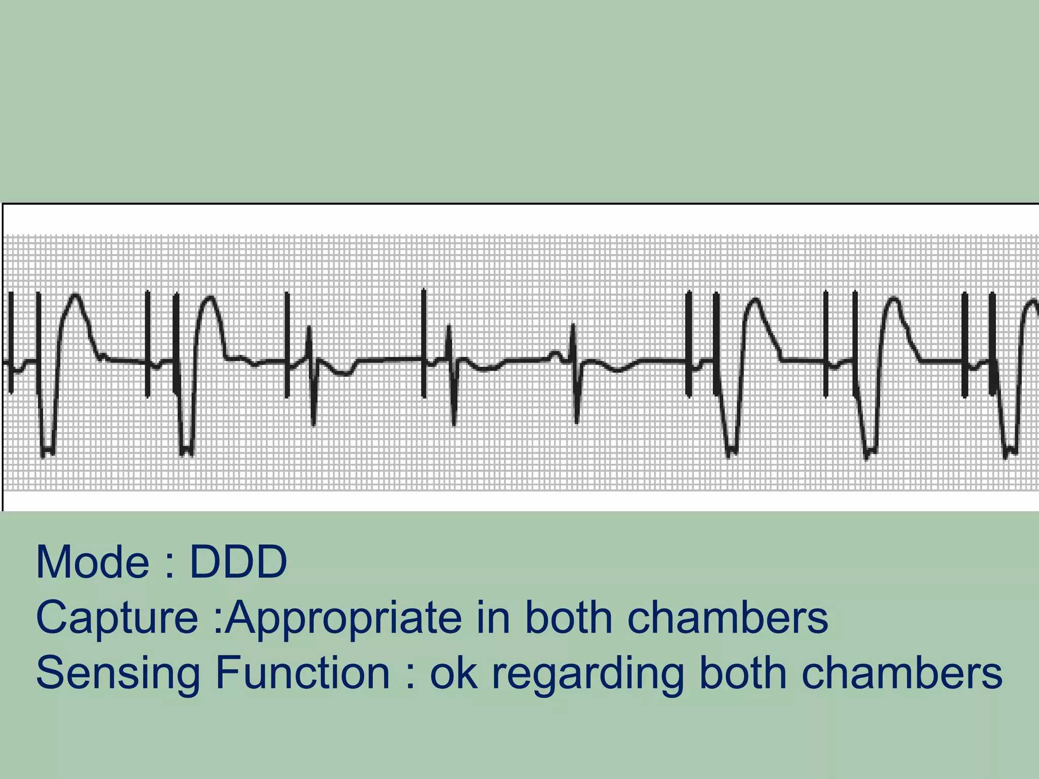 Pacemaker ECGs. Yasmeen Kamal | PPTX