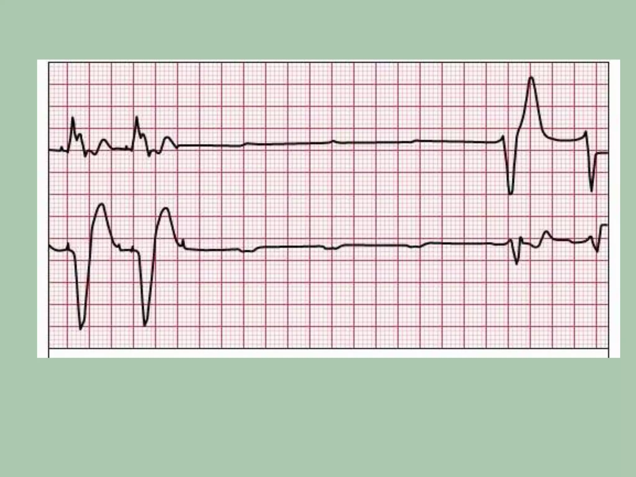 Pacemaker ECGs. Yasmeen Kamal | PPTX
