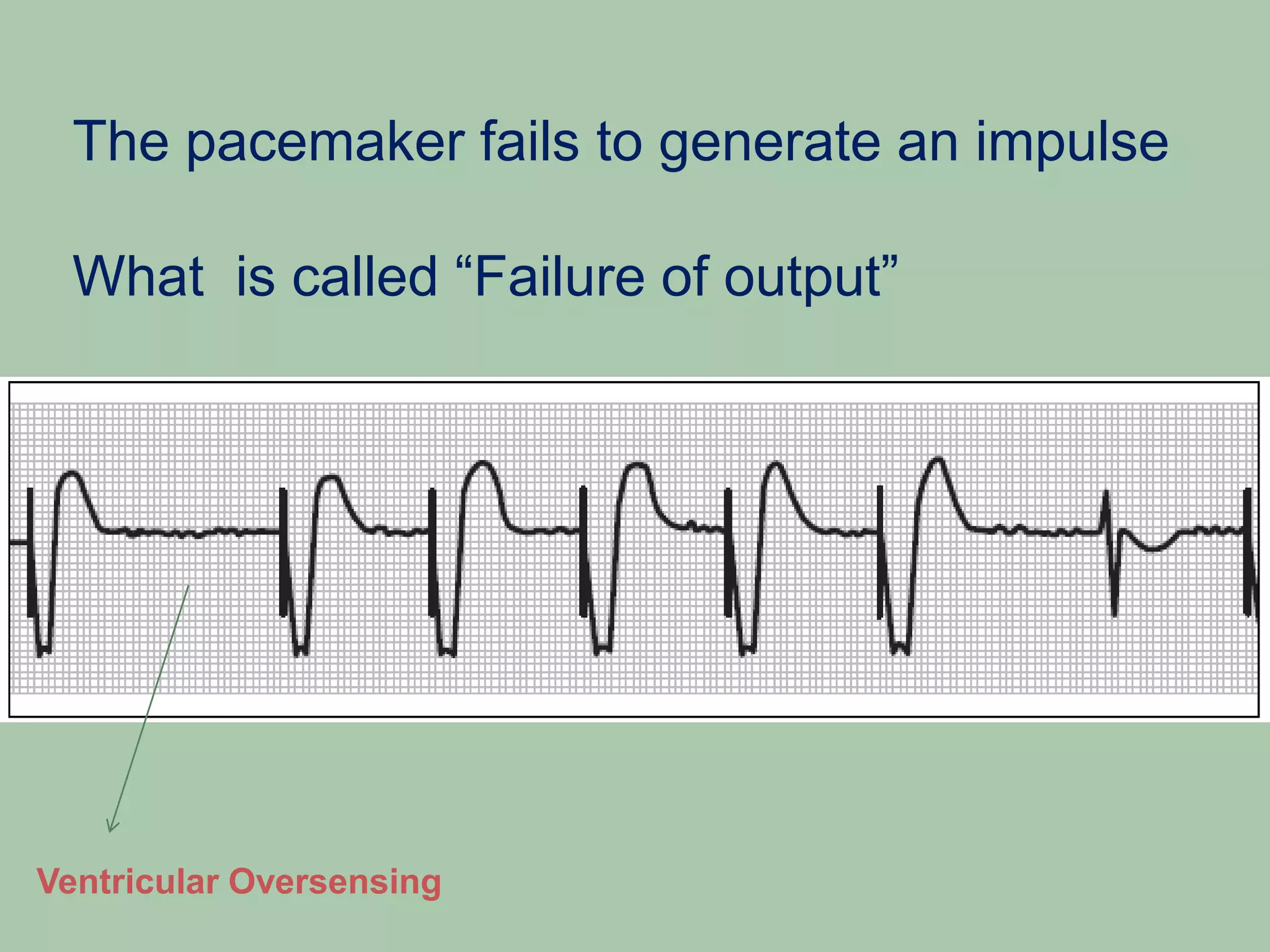 Pacemaker ECGs. Yasmeen Kamal | PPTX