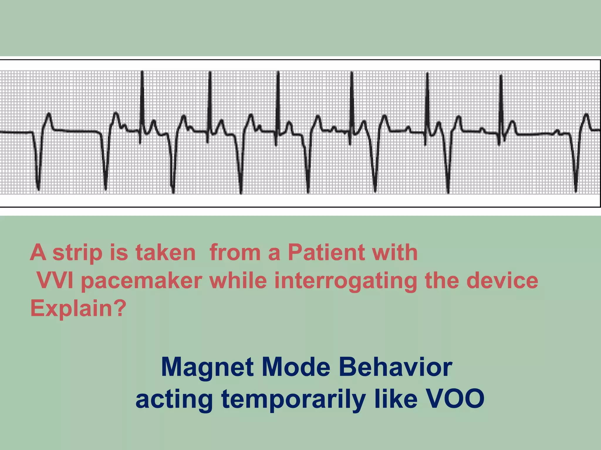 Pacemaker ECGs. Yasmeen Kamal | PPTX