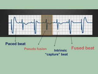 Pacemaker ECGs. Yasmeen Kamal | PPTX