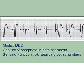 Pacemaker ECGs. Yasmeen Kamal | PPTX