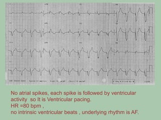 Pacemaker ECGs. Yasmeen Kamal | PPTX | Heart and Cardiovascular ...