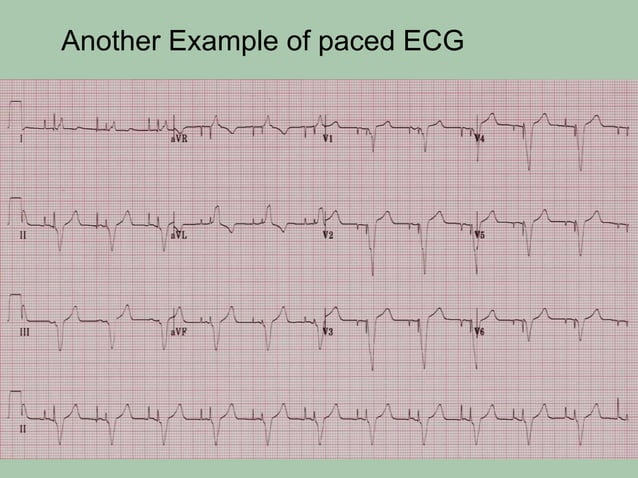 Pacemaker ECGs. Yasmeen Kamal | PPTX | Heart and Cardiovascular ...