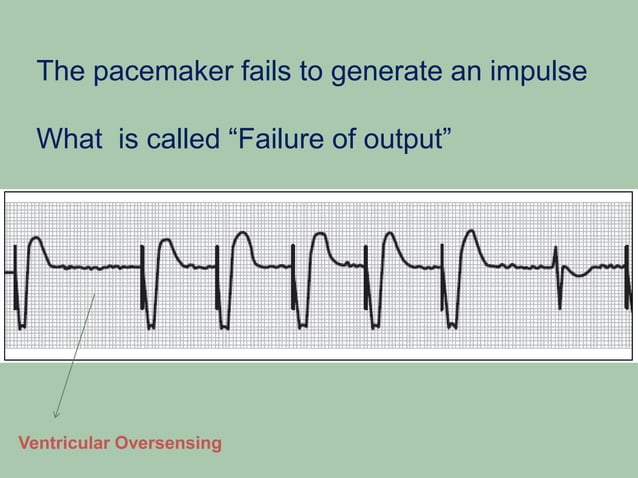 Pacemaker ECGs. Yasmeen Kamal