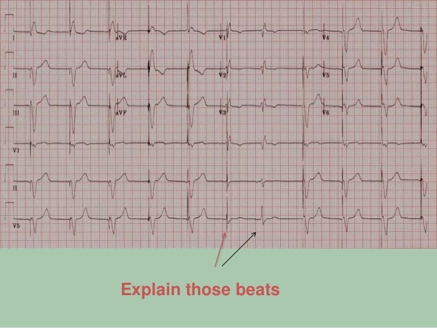 Pacemaker ECGs. Yasmeen Kamal