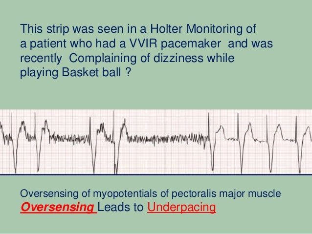 Pacemaker ECGs. Yasmeen Kamal