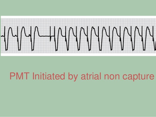 Pacemaker ECGs. Yasmeen Kamal