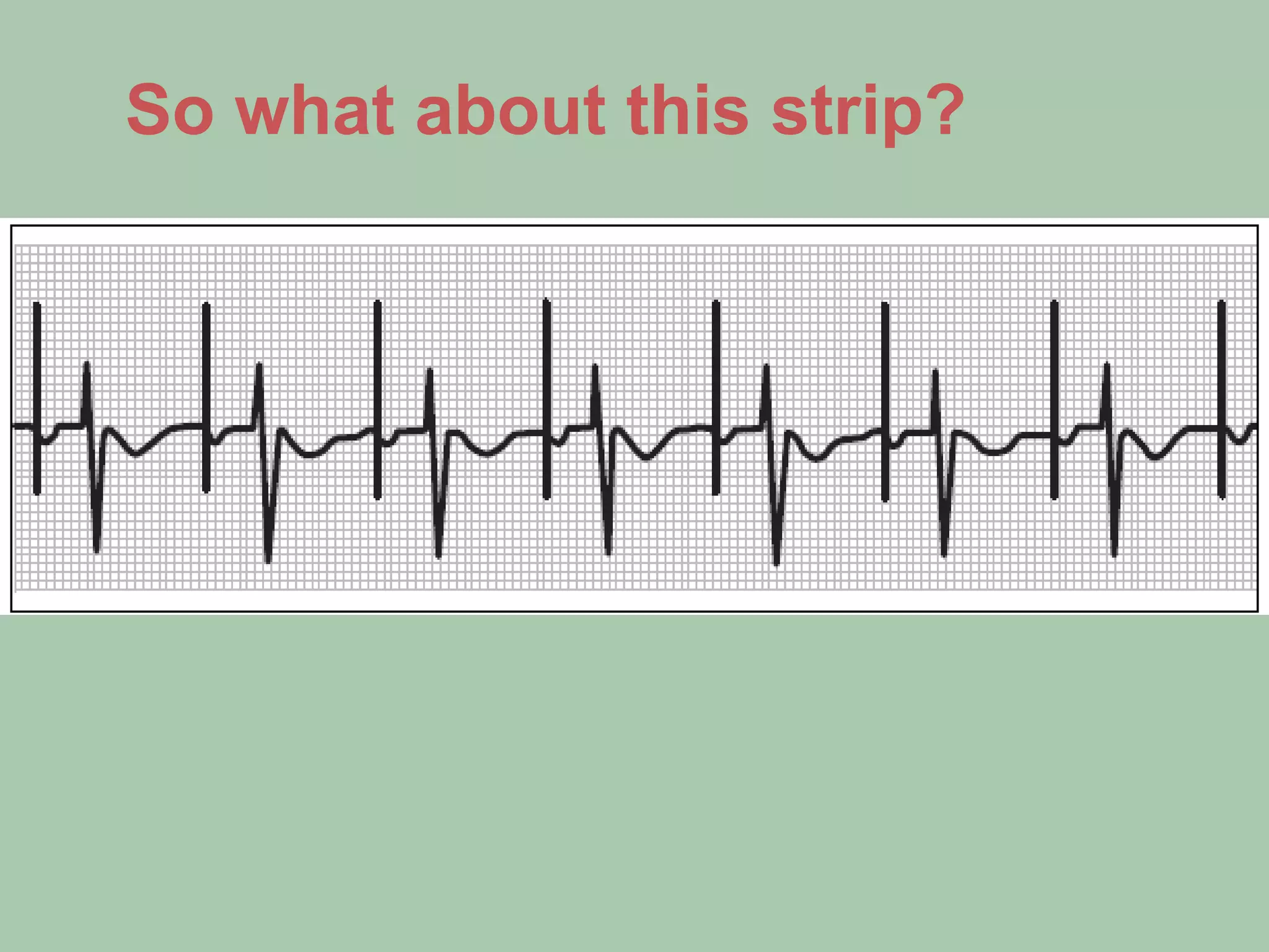 Pacemaker ECGs. Yasmeen Kamal | PPTX