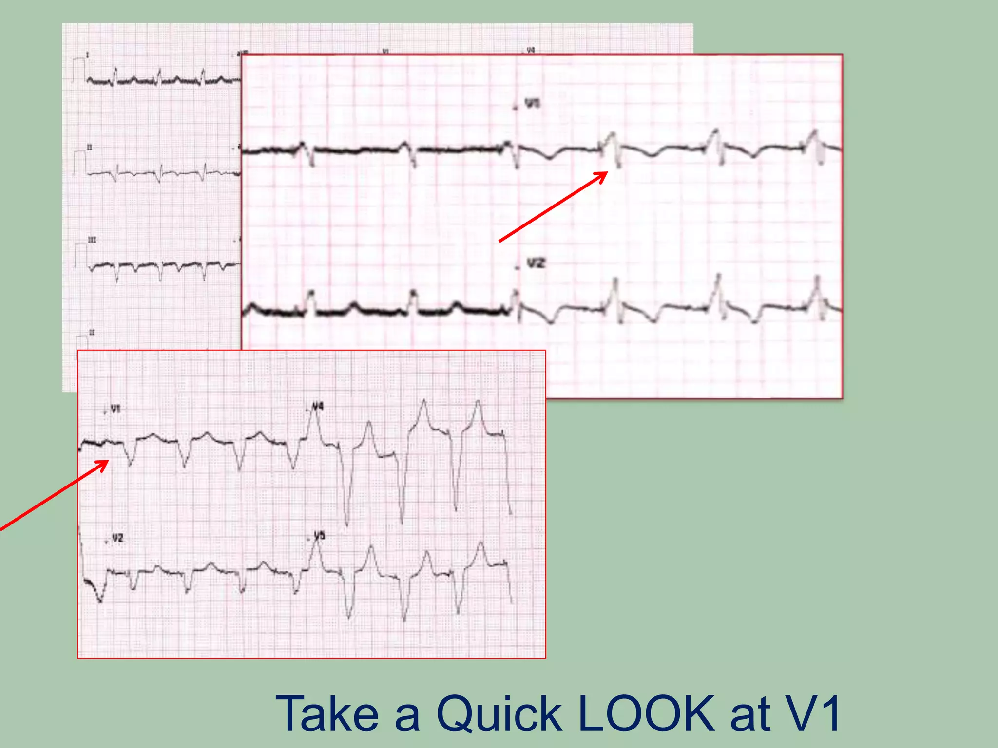 Pacemaker ECGs. Yasmeen Kamal | PPTX