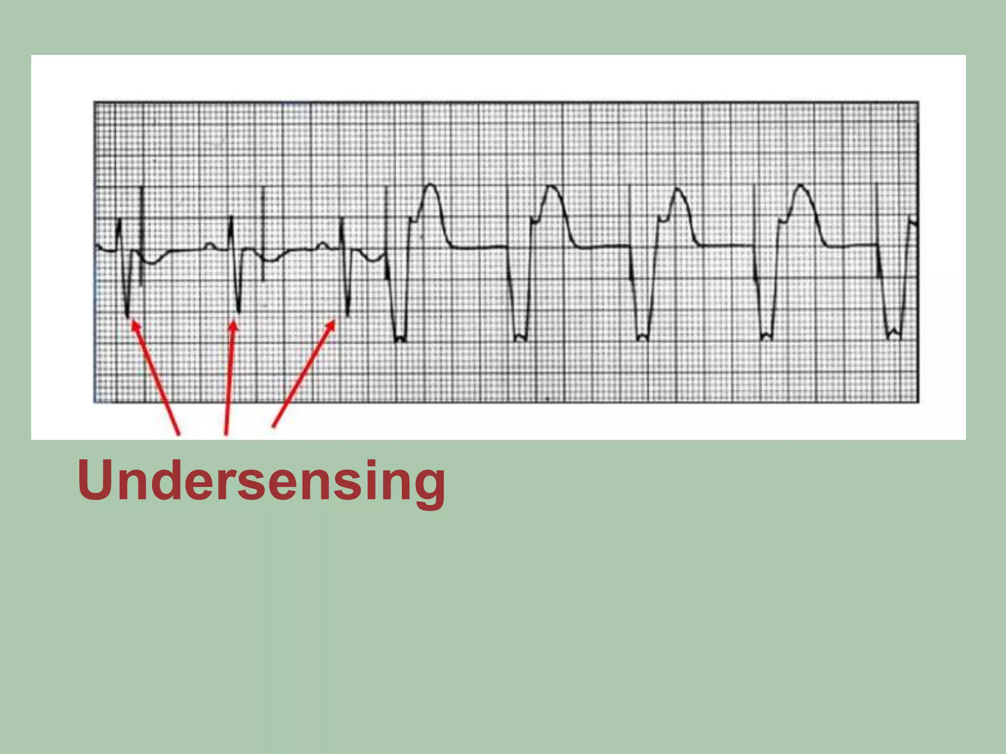 Pacemaker ECGs. Yasmeen Kamal | PPTX