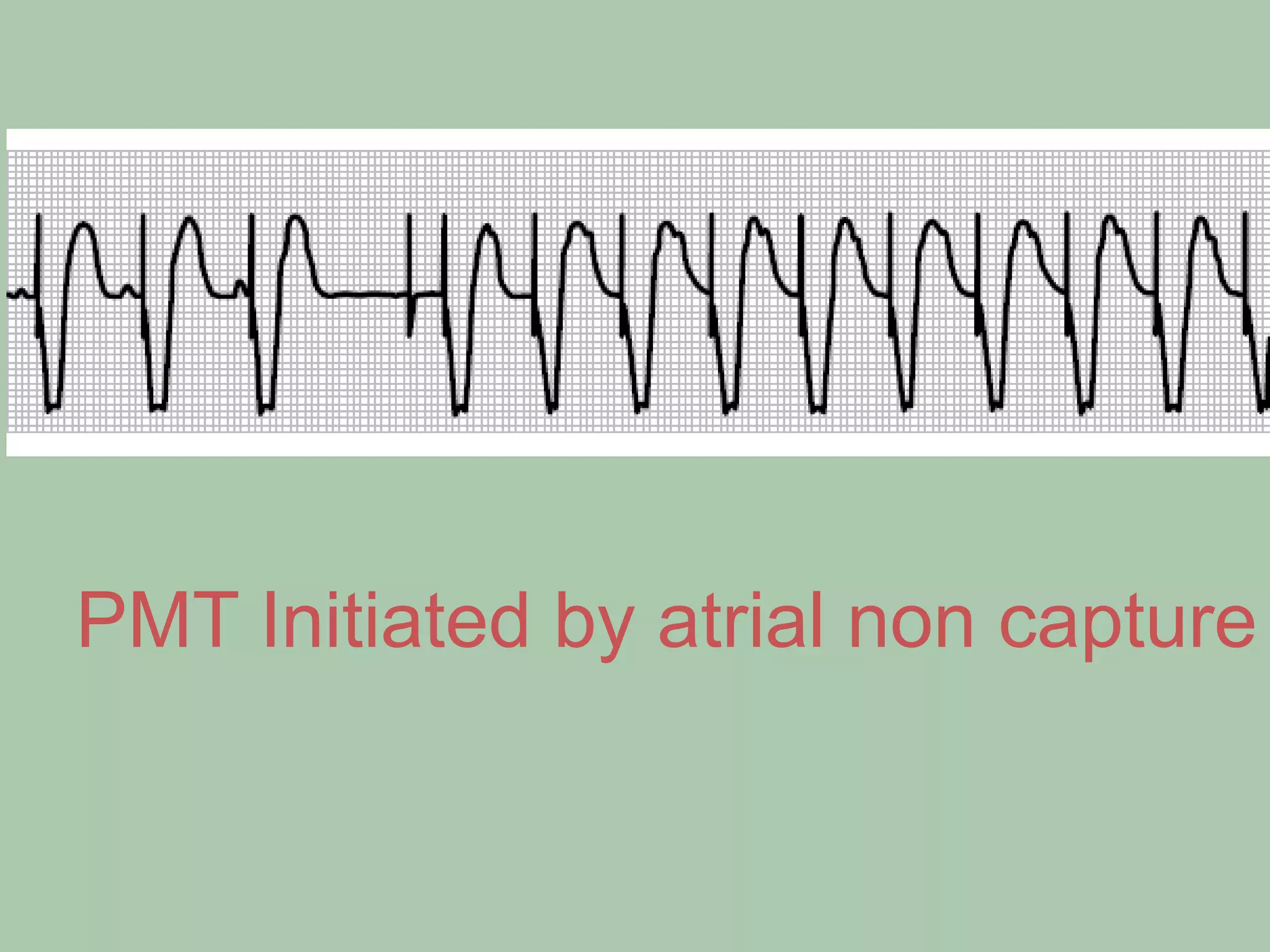 Pacemaker ECGs. Yasmeen Kamal | PPTX