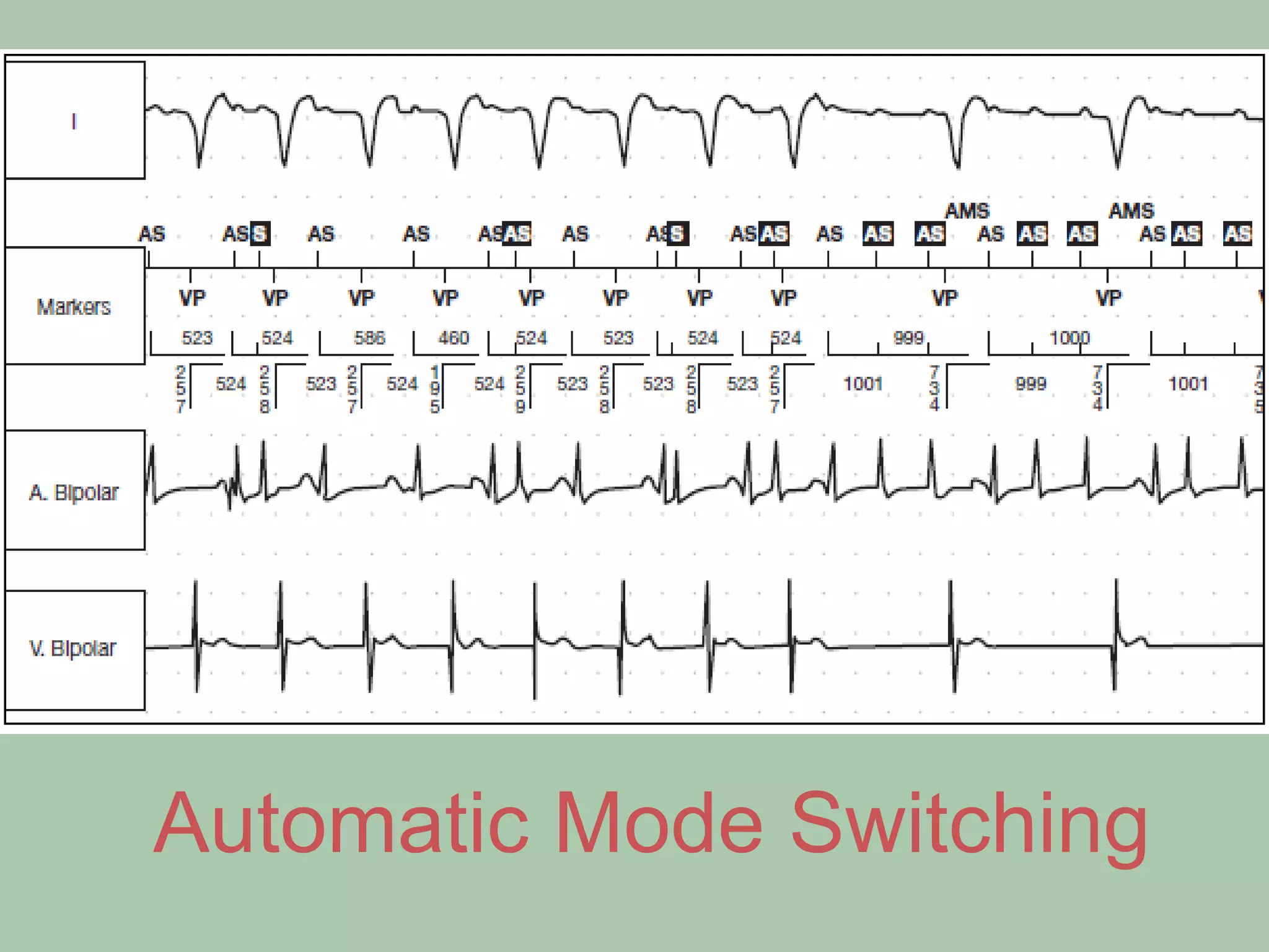 Pacemaker ECGs. Yasmeen Kamal | PPTX