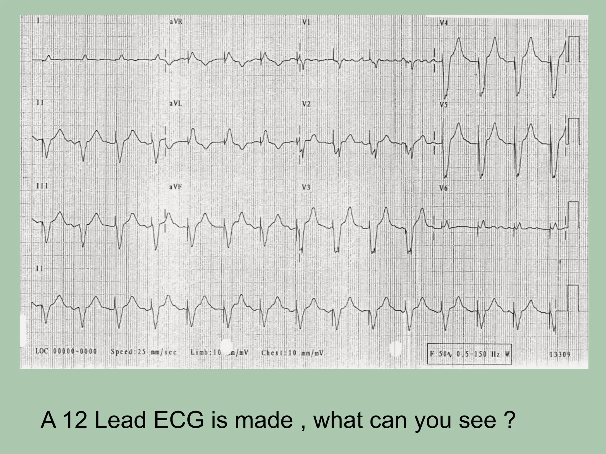 Pacemaker ECGs. Yasmeen Kamal | PPTX