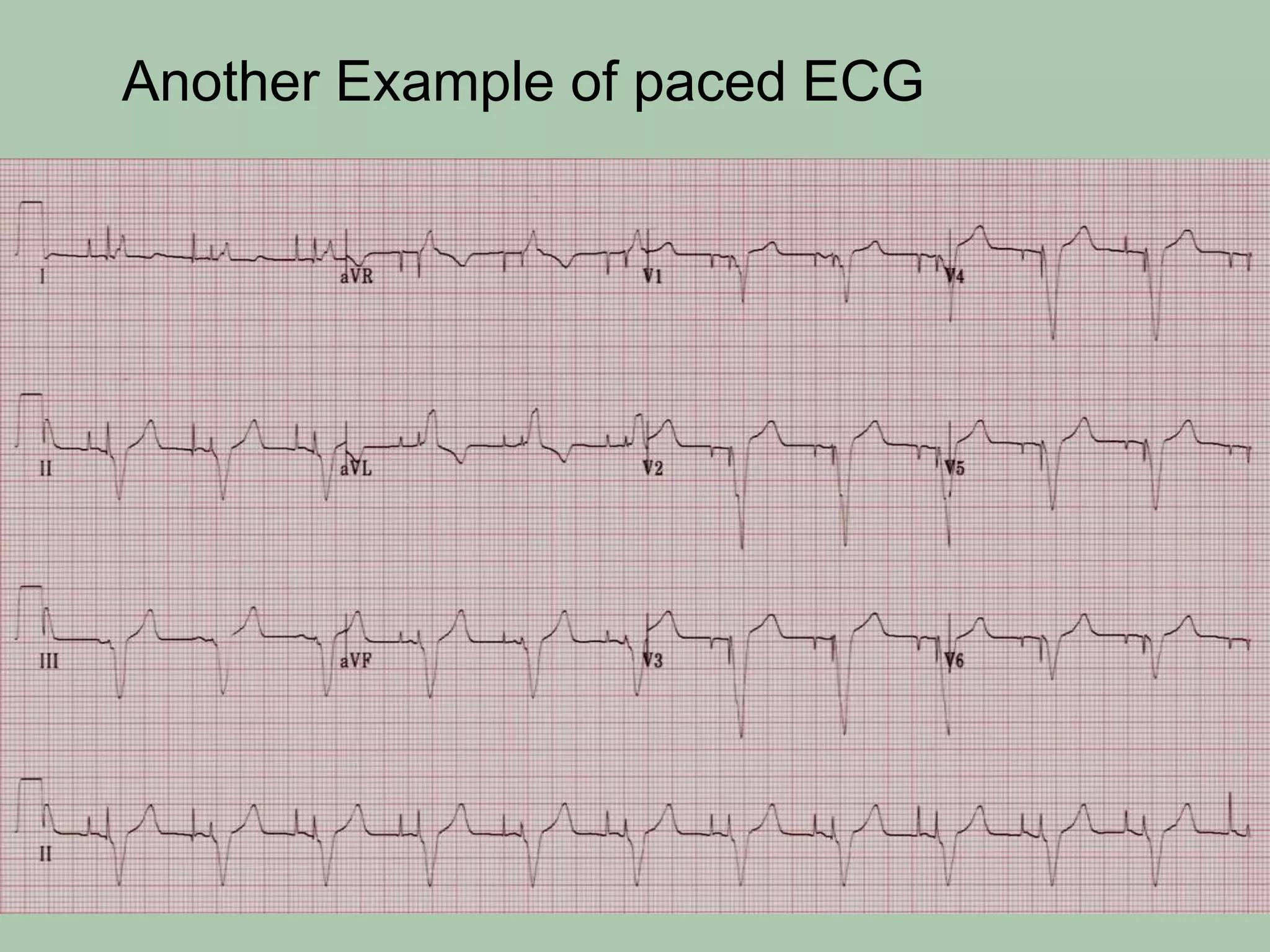 Pacemaker ECGs. Yasmeen Kamal | PPTX