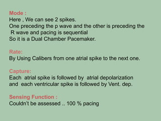 Pacemaker ECGs. Yasmeen Kamal | PPTX