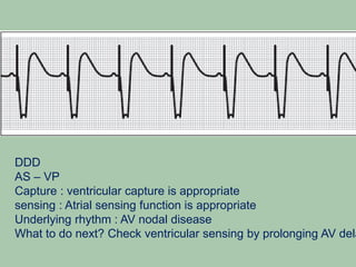 Pacemaker ECGs. Yasmeen Kamal | PPTX