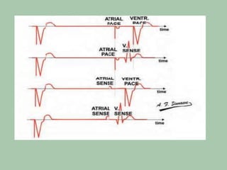 Pacemaker ECGs. Yasmeen Kamal | PPTX