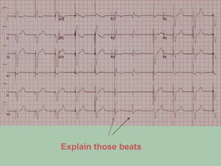 Pacemaker ECGs. Yasmeen Kamal | PPTX