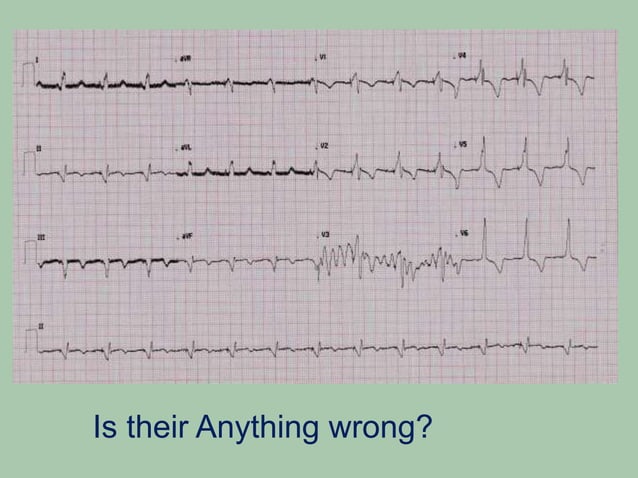 Pacemaker ECGs. Yasmeen Kamal | PPTX