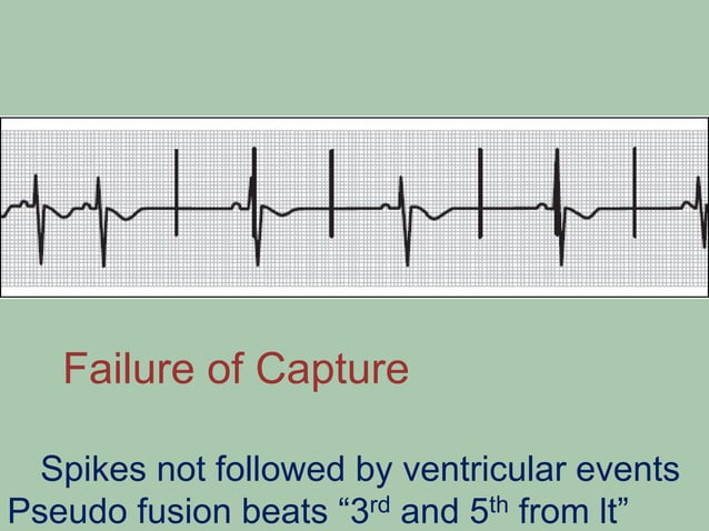Pacemaker ECGs. Yasmeen Kamal | PPTX