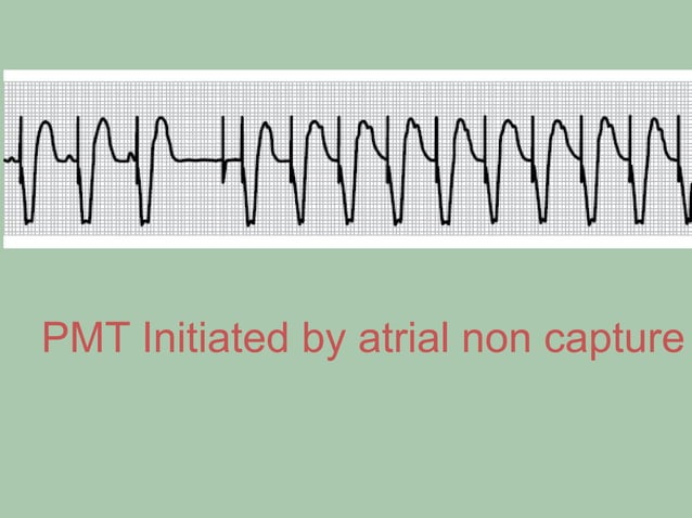 Pacemaker ECGs. Yasmeen Kamal | PPTX