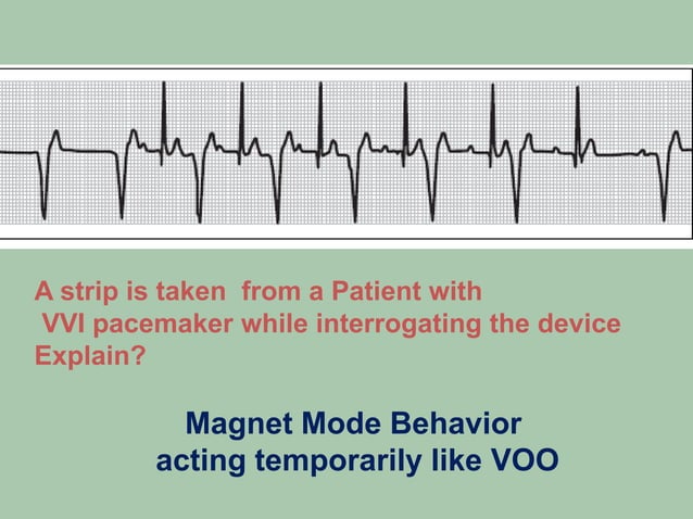 Pacemaker ECGs. Yasmeen Kamal | PPTX