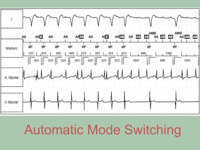 Pacemaker ECGs. Yasmeen Kamal | PPTX