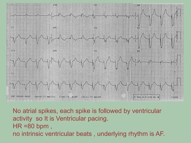 Pacemaker ECGs. Yasmeen Kamal | PPTX