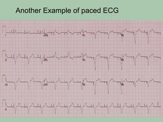 Pacemaker ECGs. Yasmeen Kamal | PPTX