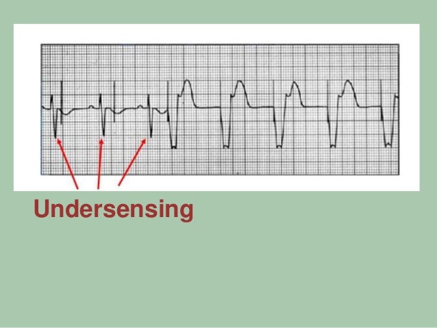 Pacemaker ECGs. Yasmeen Kamal