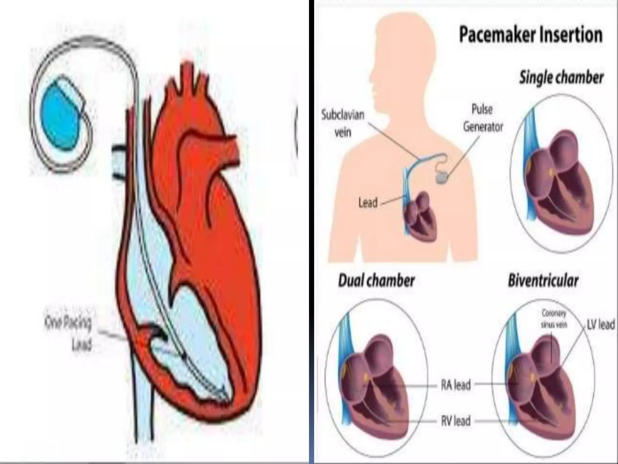 Pacemaker powerpoint presentation med surg | PPTX