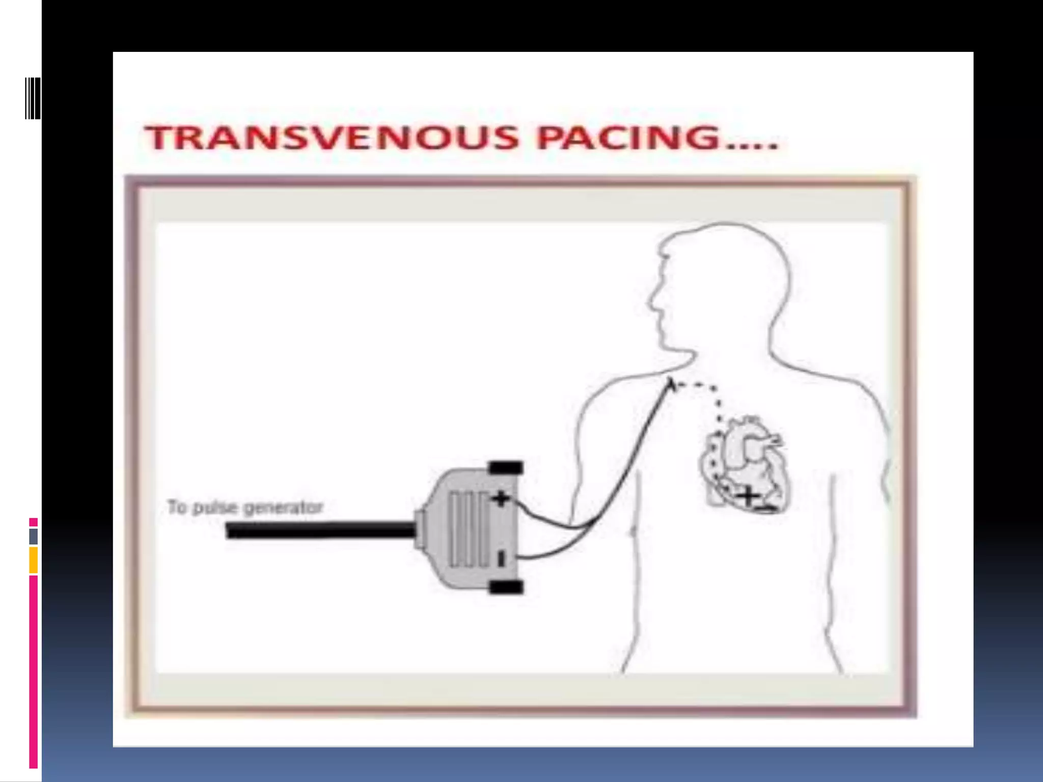 Pacemaker powerpoint presentation med surg | PPTX